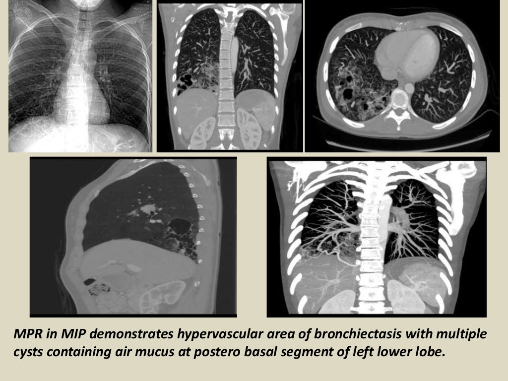 Presentation1.pptx, radiological imaging of bronchiectasis.