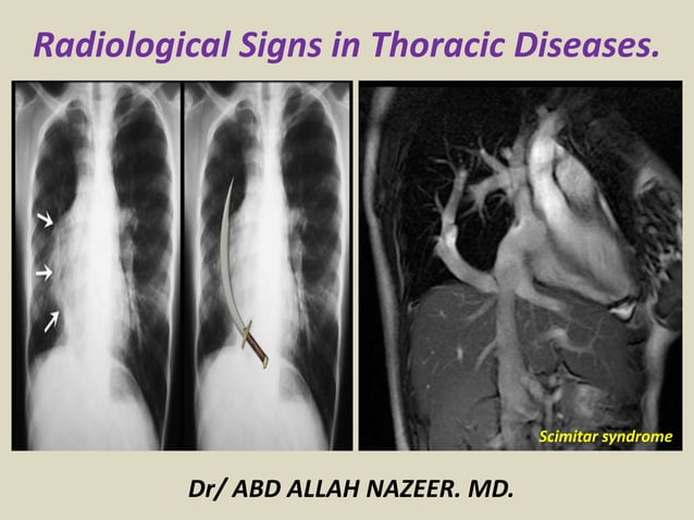 Presentation1.pptx, radiological signs in thoracic radiology. | PPTX ...