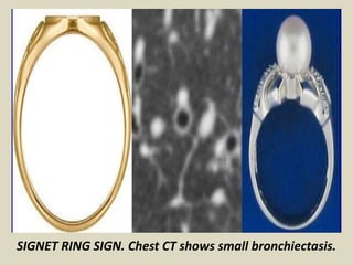 Presentation1.pptx, radiological signs in thoracic radiology. | PPTX