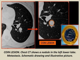 Presentation1.pptx, radiological signs in thoracic radiology. | PPTX