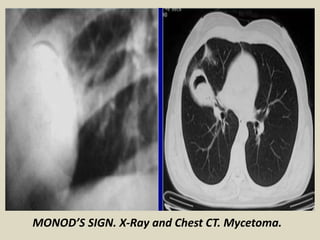 Presentation1.pptx, radiological signs in thoracic radiology. | PPTX
