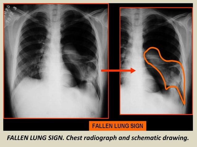 Presentation1.pptx, radiological signs in thoracic radiology. | PPTX ...
