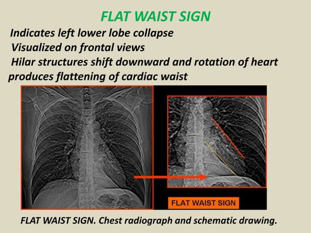 Presentation1.pptx, radiological signs in thoracic radiology. | PPTX ...