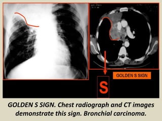 Presentation1.pptx, radiological signs in thoracic radiology. | PPTX