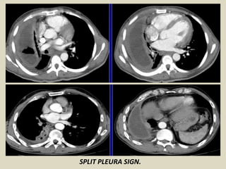 Presentation1.pptx, radiological signs in thoracic radiology. | PPTX