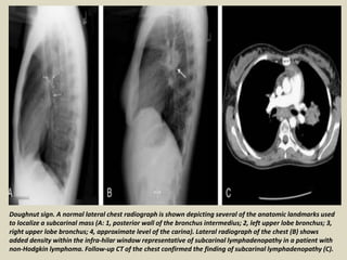 Presentation1.pptx, radiological signs in thoracic radiology. | PPTX