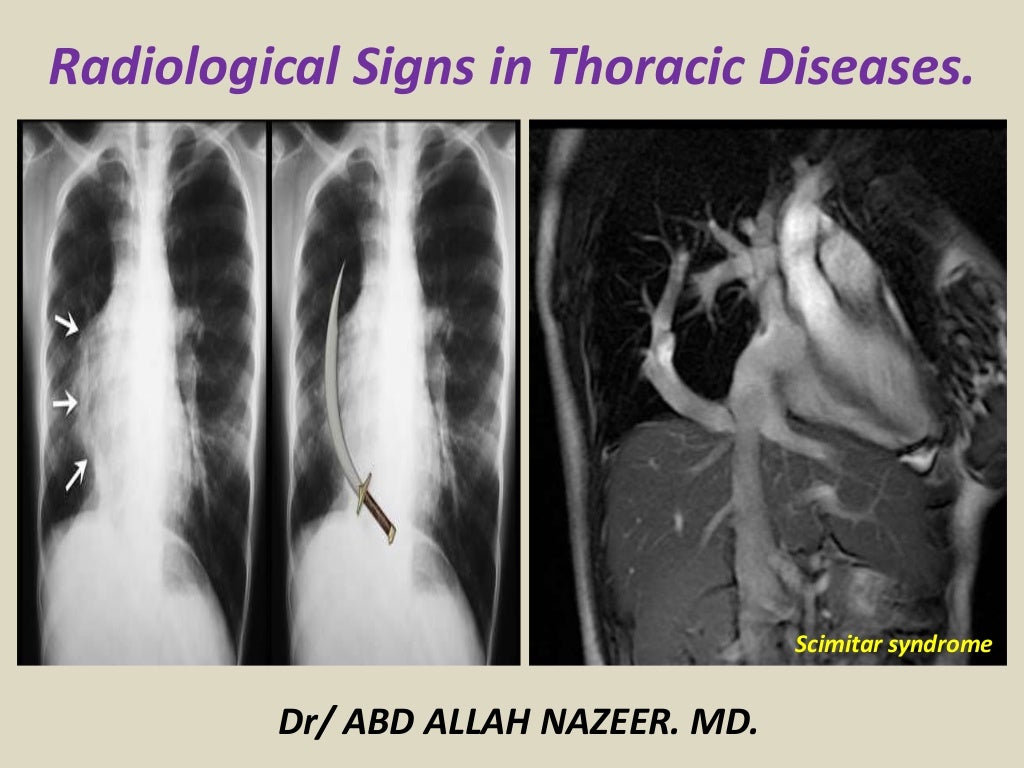 Presentation1.pptx, radiological signs in thoracic radiology.