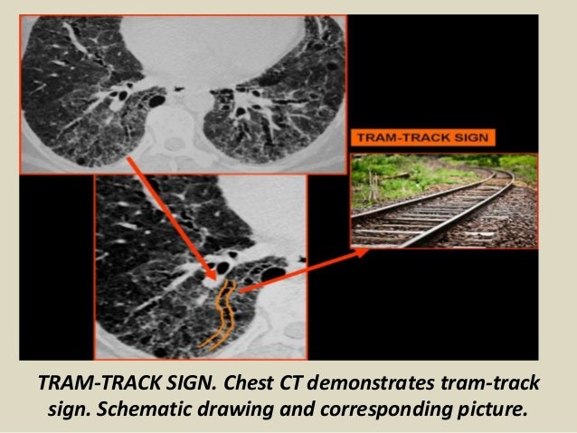 Presentation1.pptx, radiological signs in thoracic radiology.