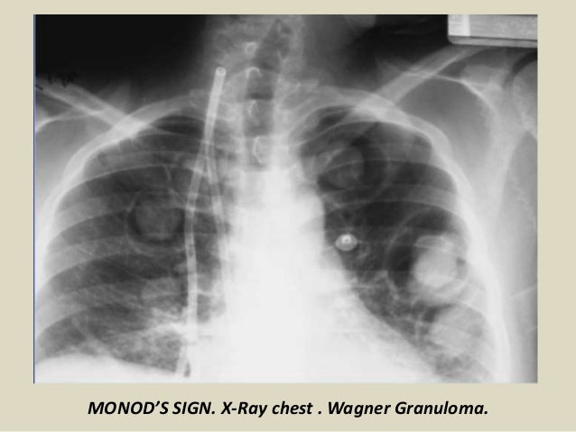 Presentation1.pptx, radiological signs in thoracic radiology.