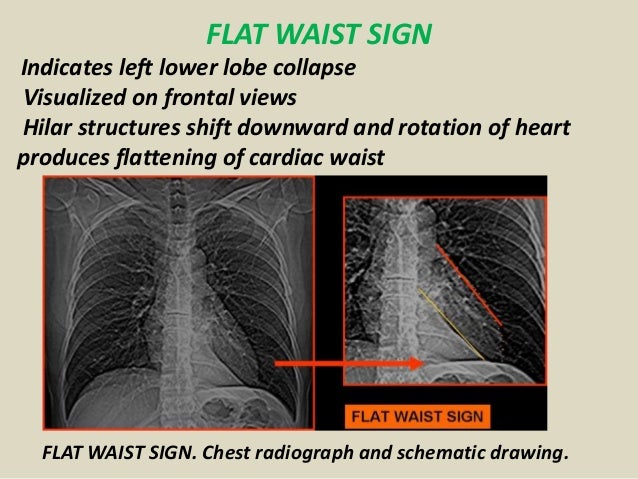 Presentation1.pptx, radiological signs in thoracic radiology.