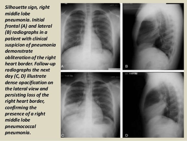 Presentation1.pptx, radiological signs in thoracic radiology.