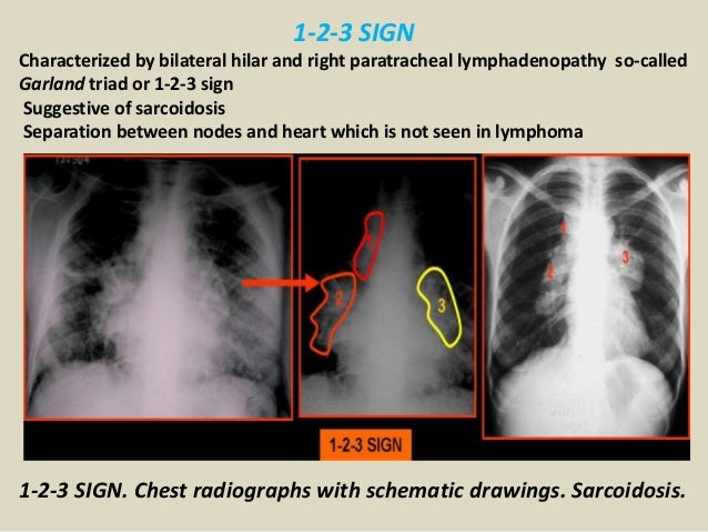 Presentation1.pptx, radiological signs in thoracic radiology.