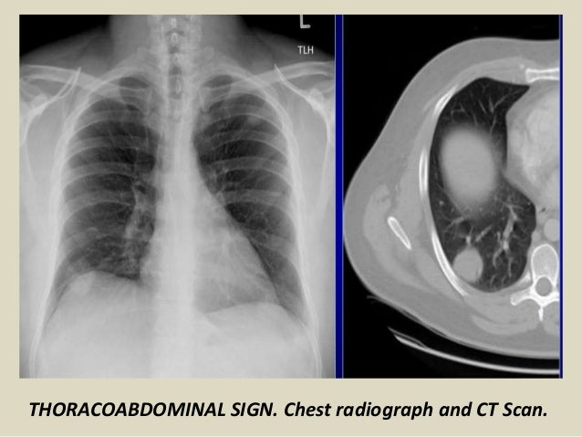 Presentation1.pptx, radiological signs in thoracic radiology.