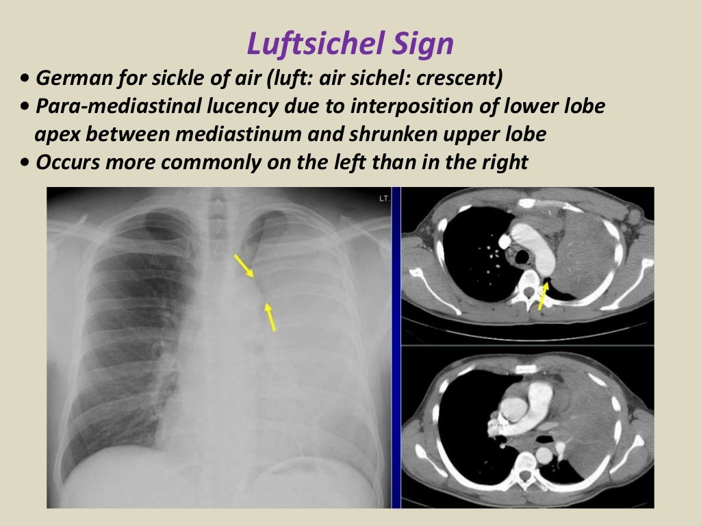 Presentation1.pptx, radiological signs in thoracic radiology.