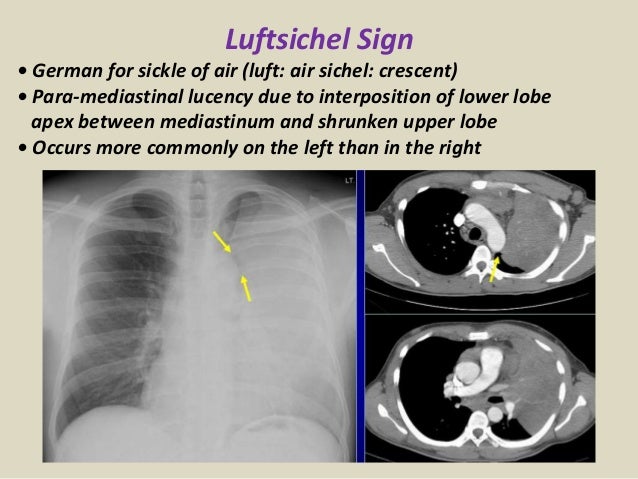 Presentation1.pptx, radiological signs in thoracic radiology.