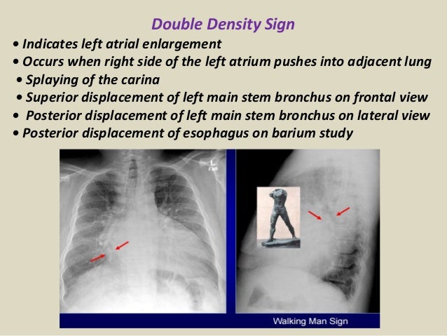 Presentation1.pptx, radiological signs in thoracic radiology.