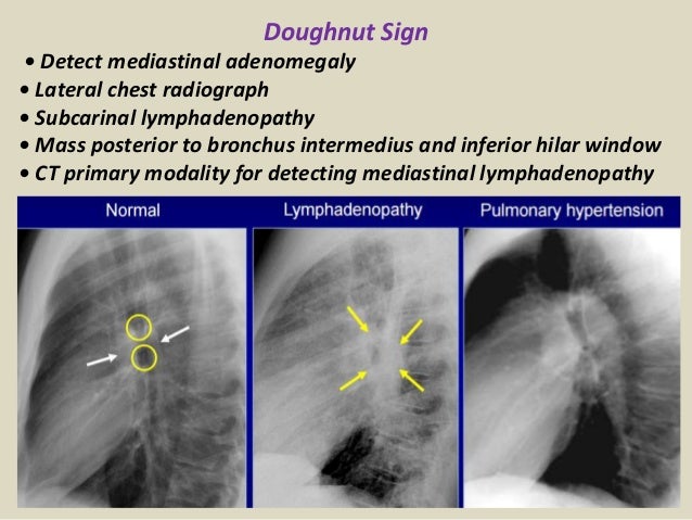 Presentation1.pptx, radiological signs in thoracic radiology.