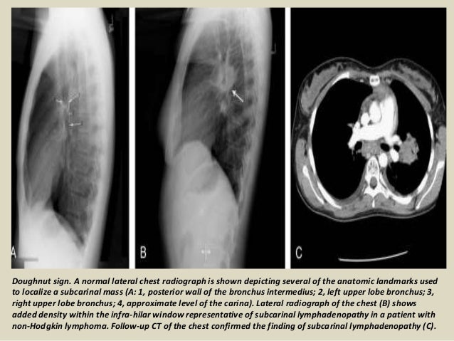 Presentation1.pptx, radiological signs in thoracic radiology.