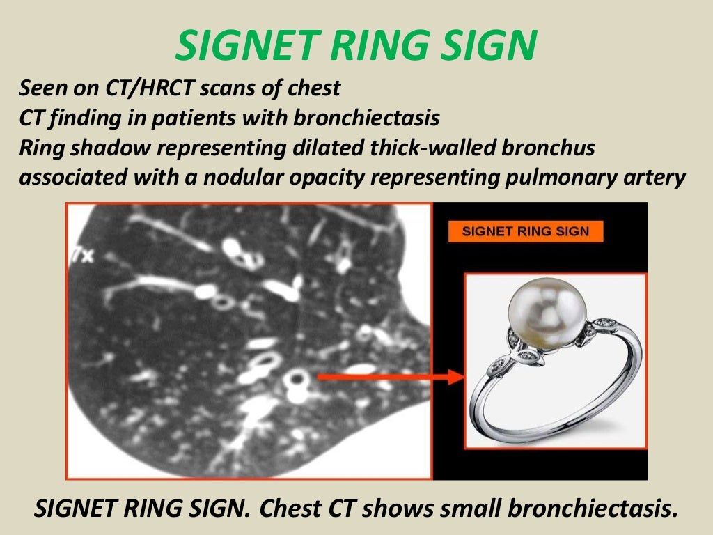 Presentation1.pptx, radiological signs in thoracic radiology.