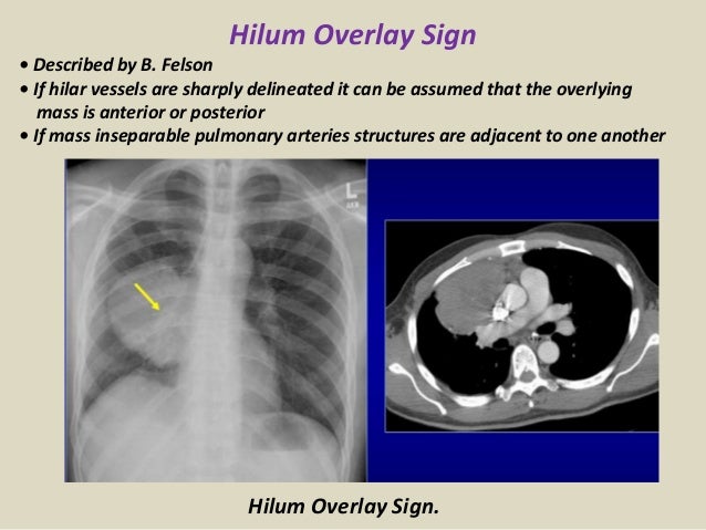 Presentation1.pptx, radiological signs in thoracic radiology.