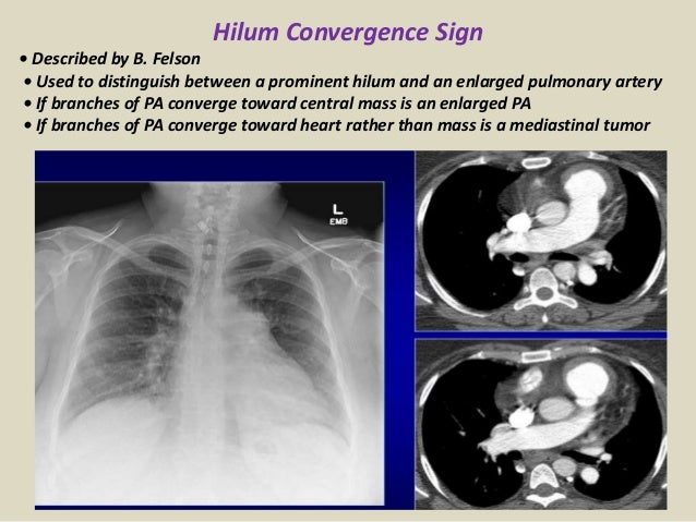 Presentation1.pptx, radiological signs in thoracic radiology.