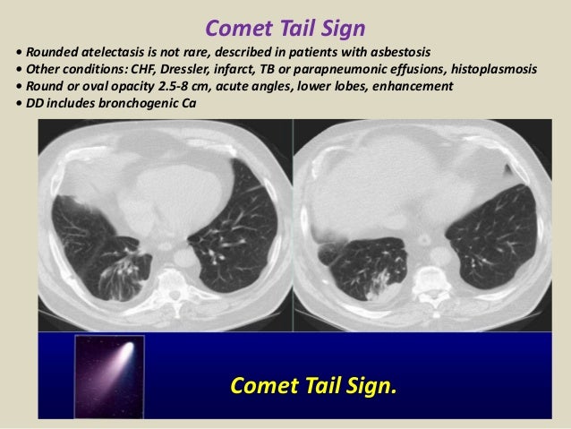 Presentation1.pptx, radiological signs in thoracic radiology.