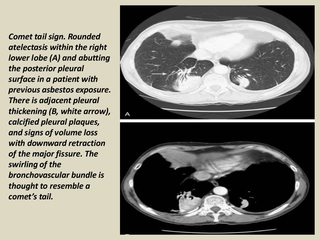 Presentation1.pptx, radiological signs in thoracic radiology.