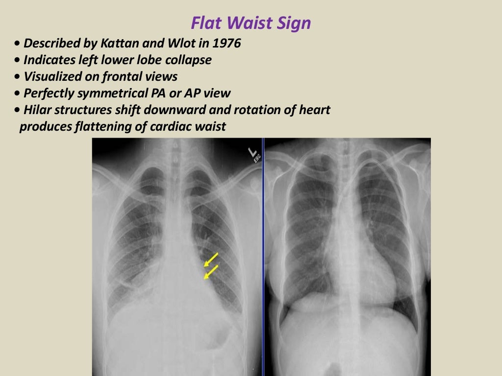 Presentation1.pptx, radiological signs in thoracic radiology.