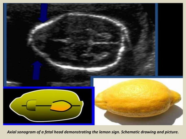 Presentation1.pptx, radiological classical signs and appearances in ...