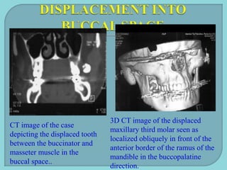 impacted maxillary 3rd molar & canine | PPTX