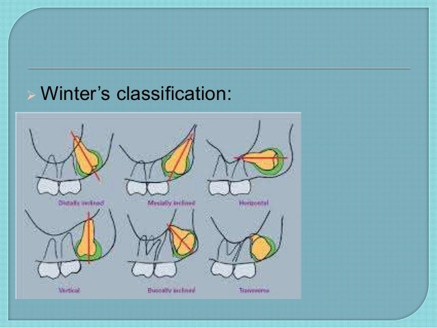 impacted maxillary 3rd molar & canine