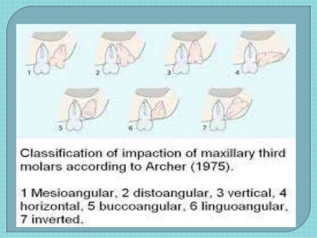 impacted maxillary 3rd molar & canine