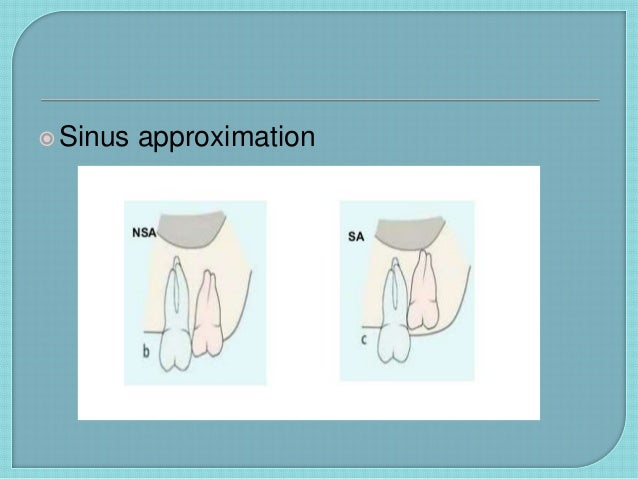impacted maxillary 3rd molar & canine