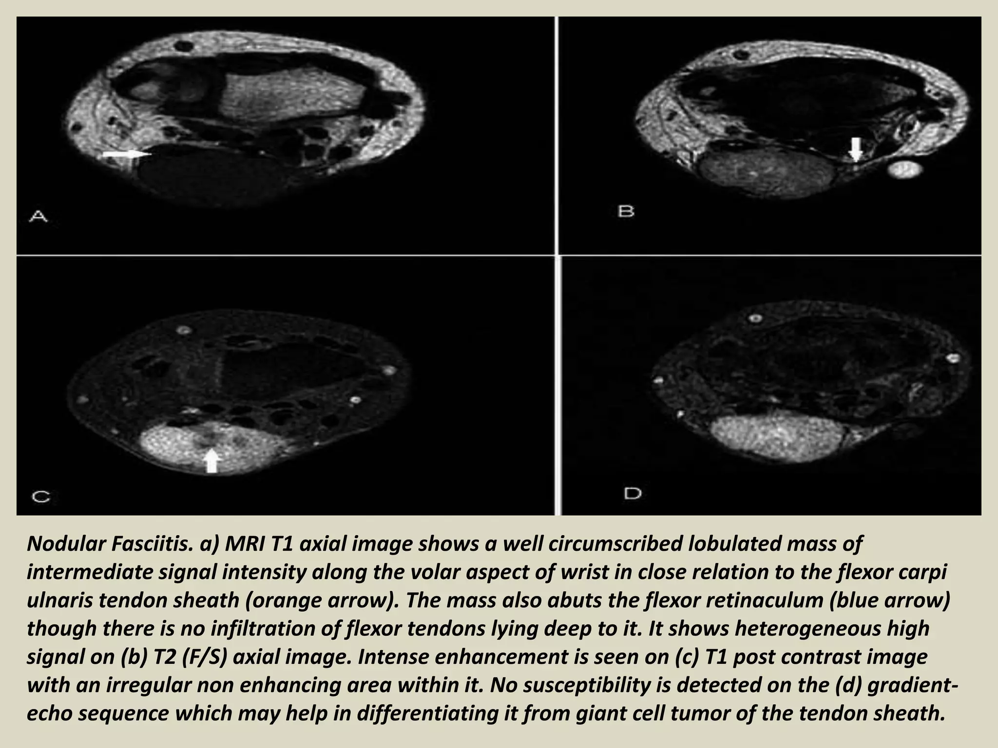Presentation1.pptx, radiological imaging of soft tissue masses of the ...