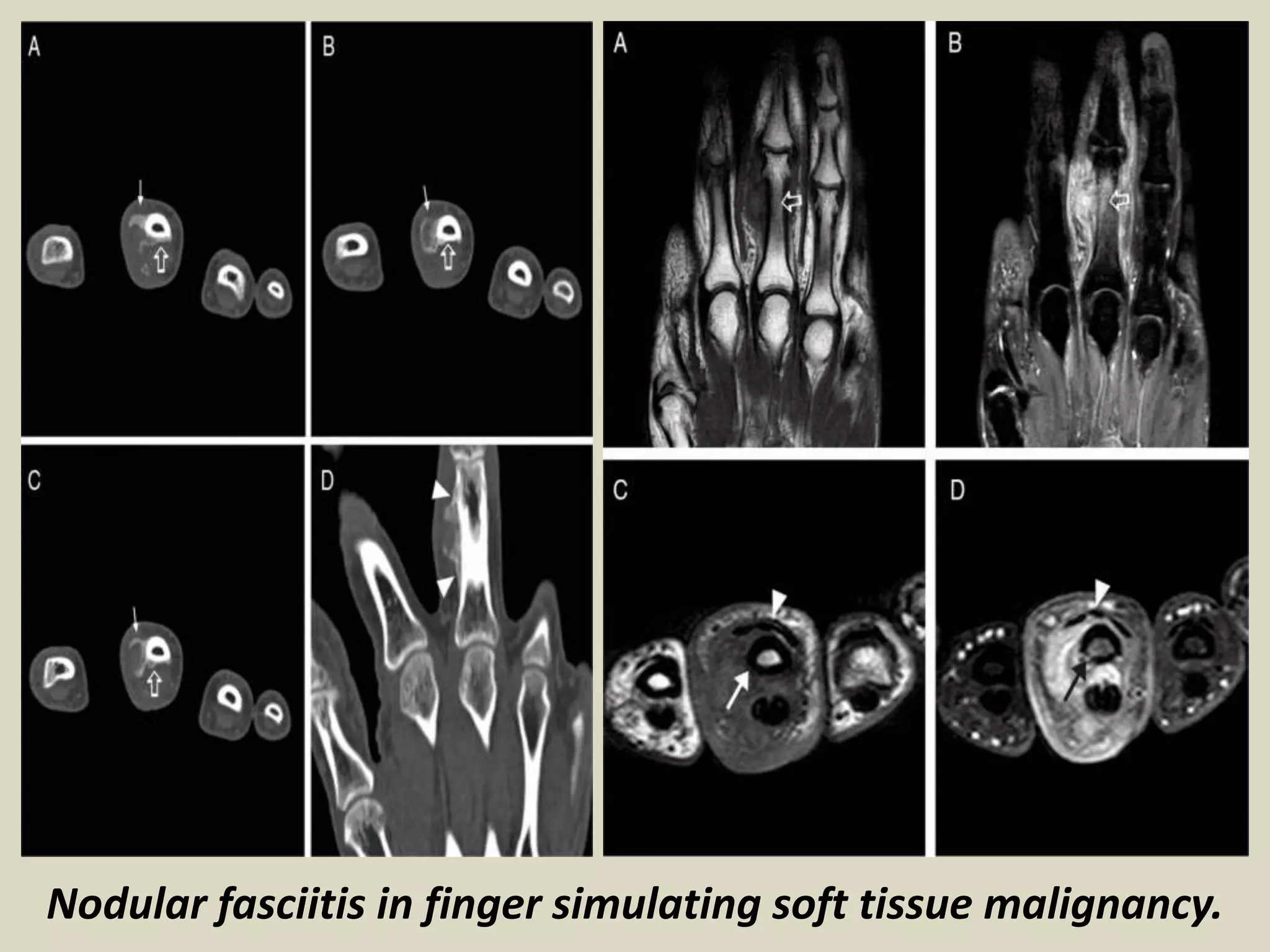 Presentation1.pptx, radiological imaging of soft tissue masses of the ...