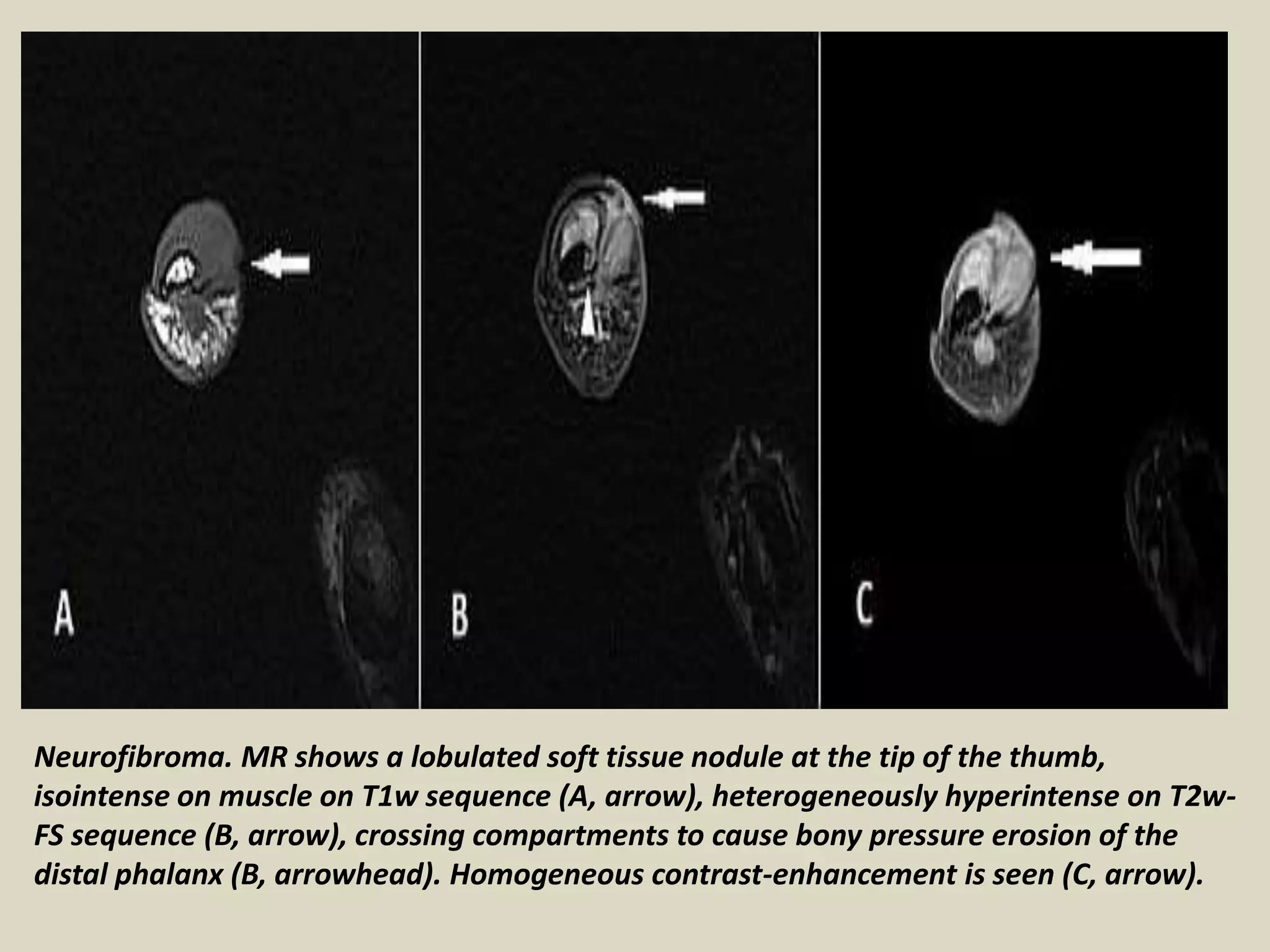 Presentation1.pptx, radiological imaging of soft tissue masses of the ...