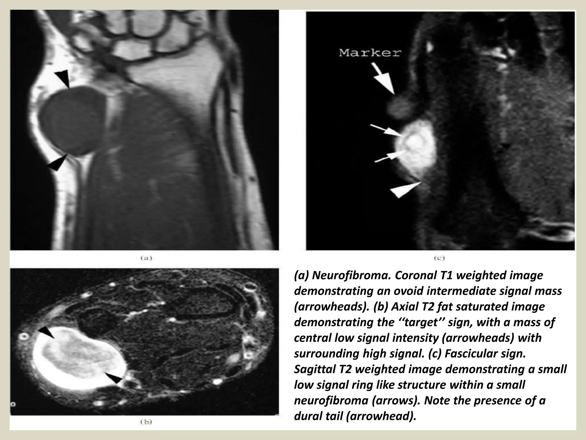 Presentation1.pptx, radiological imaging of soft tissue masses of the ...