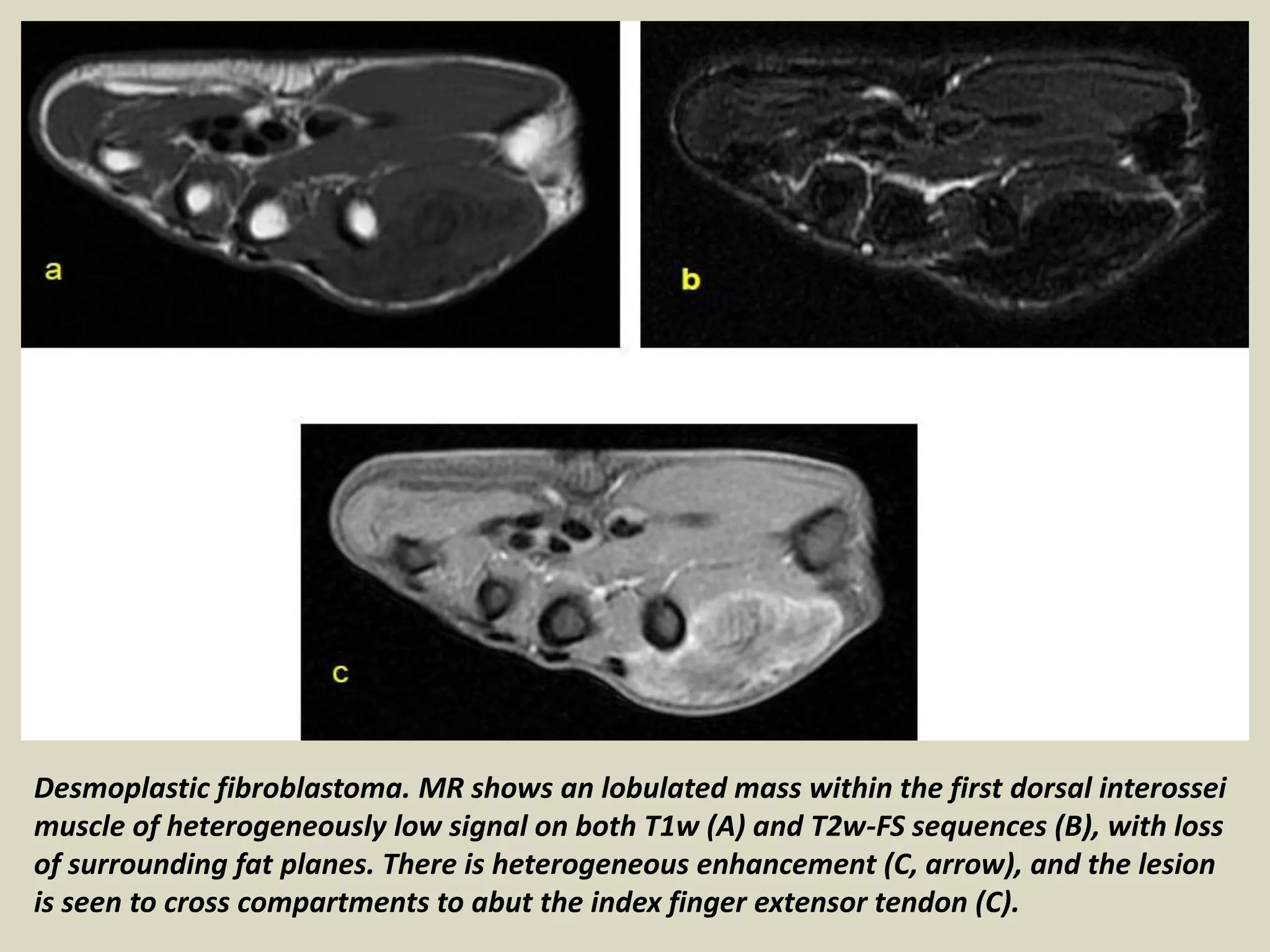 Presentation1.pptx, radiological imaging of soft tissue masses of the ...