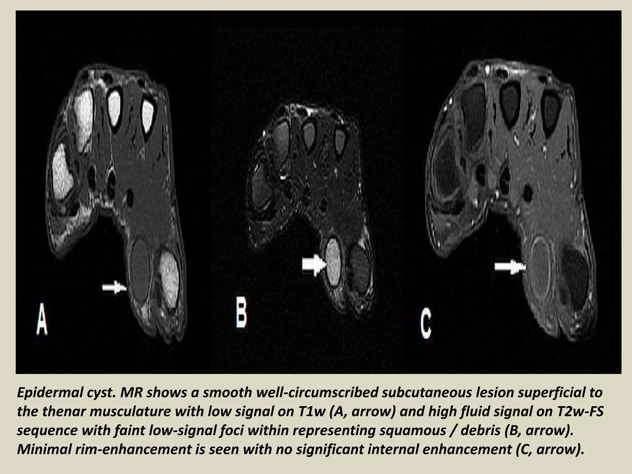Presentation1.pptx, radiological imaging of soft tissue masses of the ...