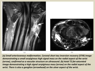 Presentation1.pptx, radiological imaging of soft tissue masses of the ...