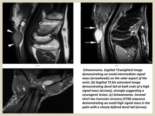 Presentation1.pptx, radiological imaging of soft tissue masses of the ...
