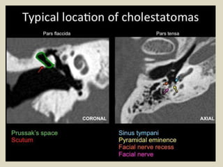 Prussak Space Ct Scan