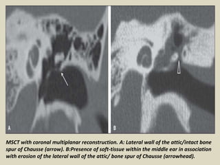 Prussak Space Ct Scan