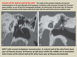 Prussak Space Ct Scan