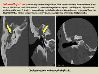 Cholesteatoma Radiology