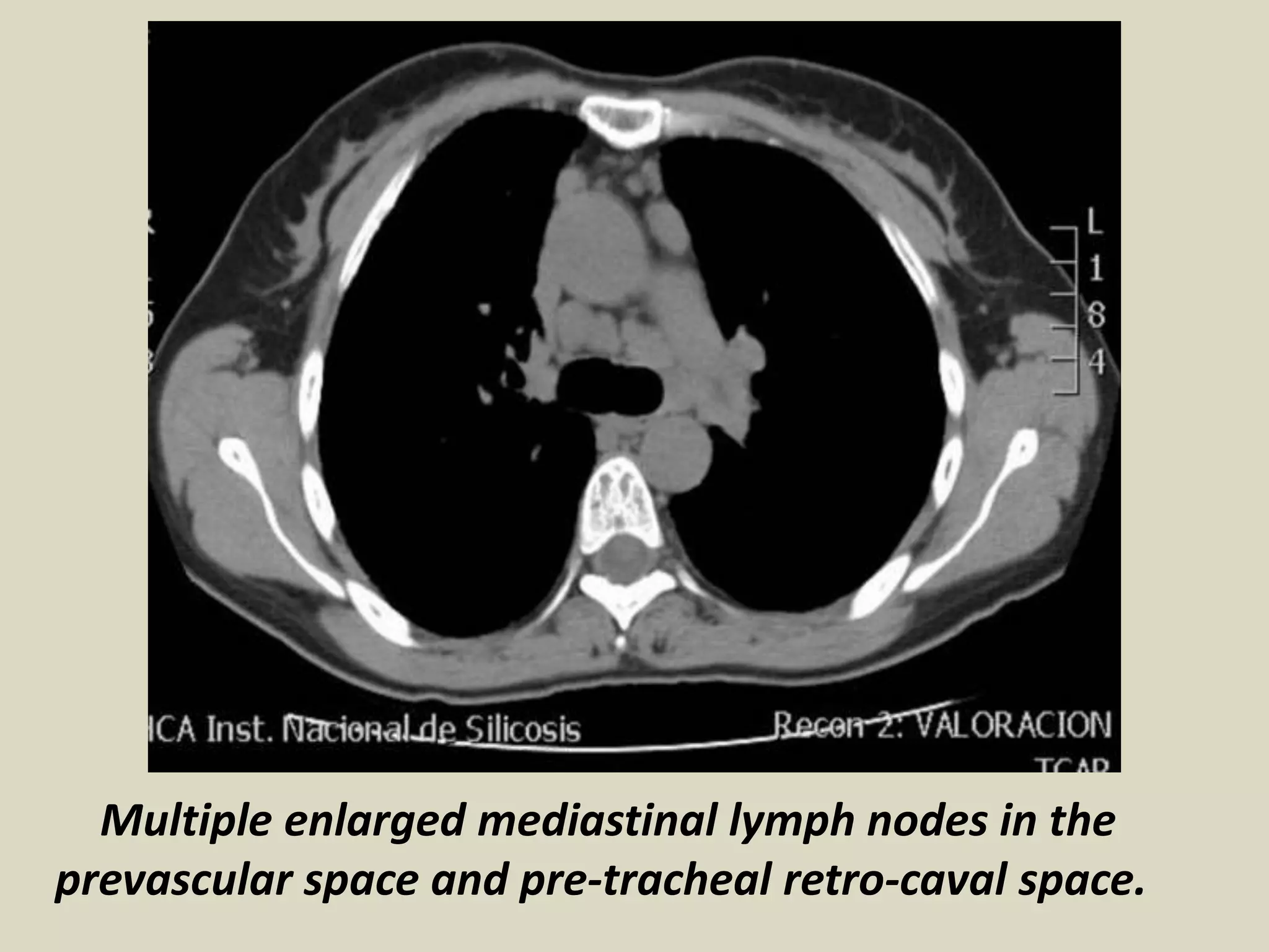 Presentation1.pptx, radiological imaging of sarcoidosis. | PPTX