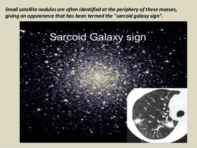 Presentation1.pptx, radiological imaging of sarcoidosis.