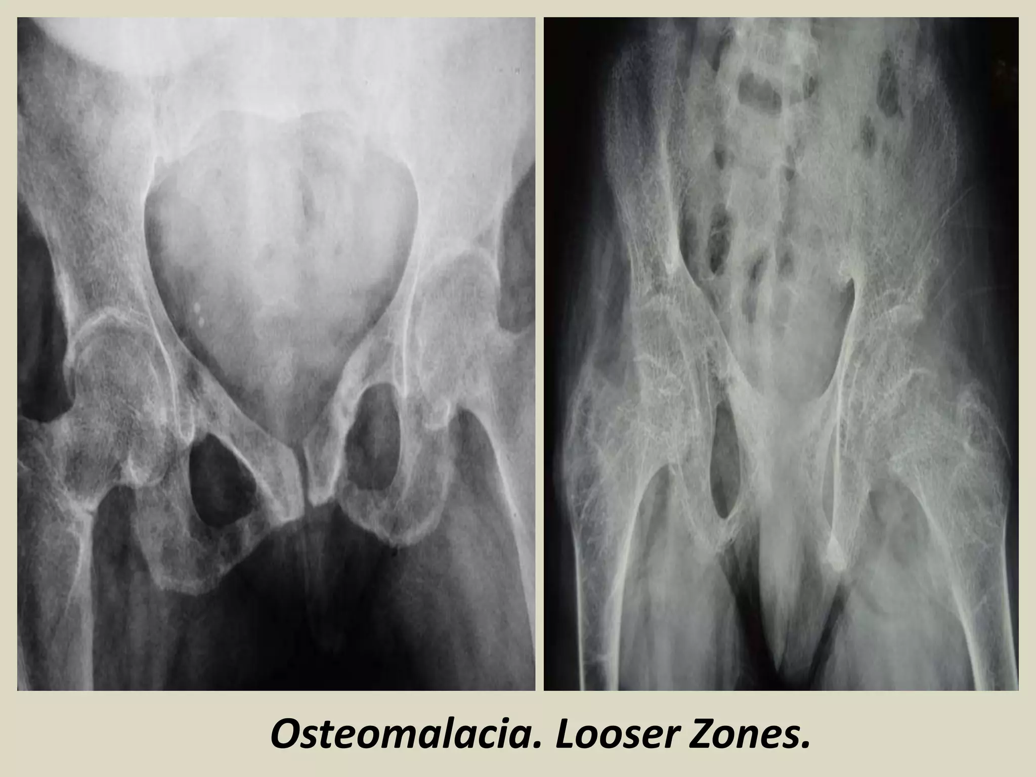 Presentation1.pptx, radiological imaging of metabolic bone diseases. | PPTX