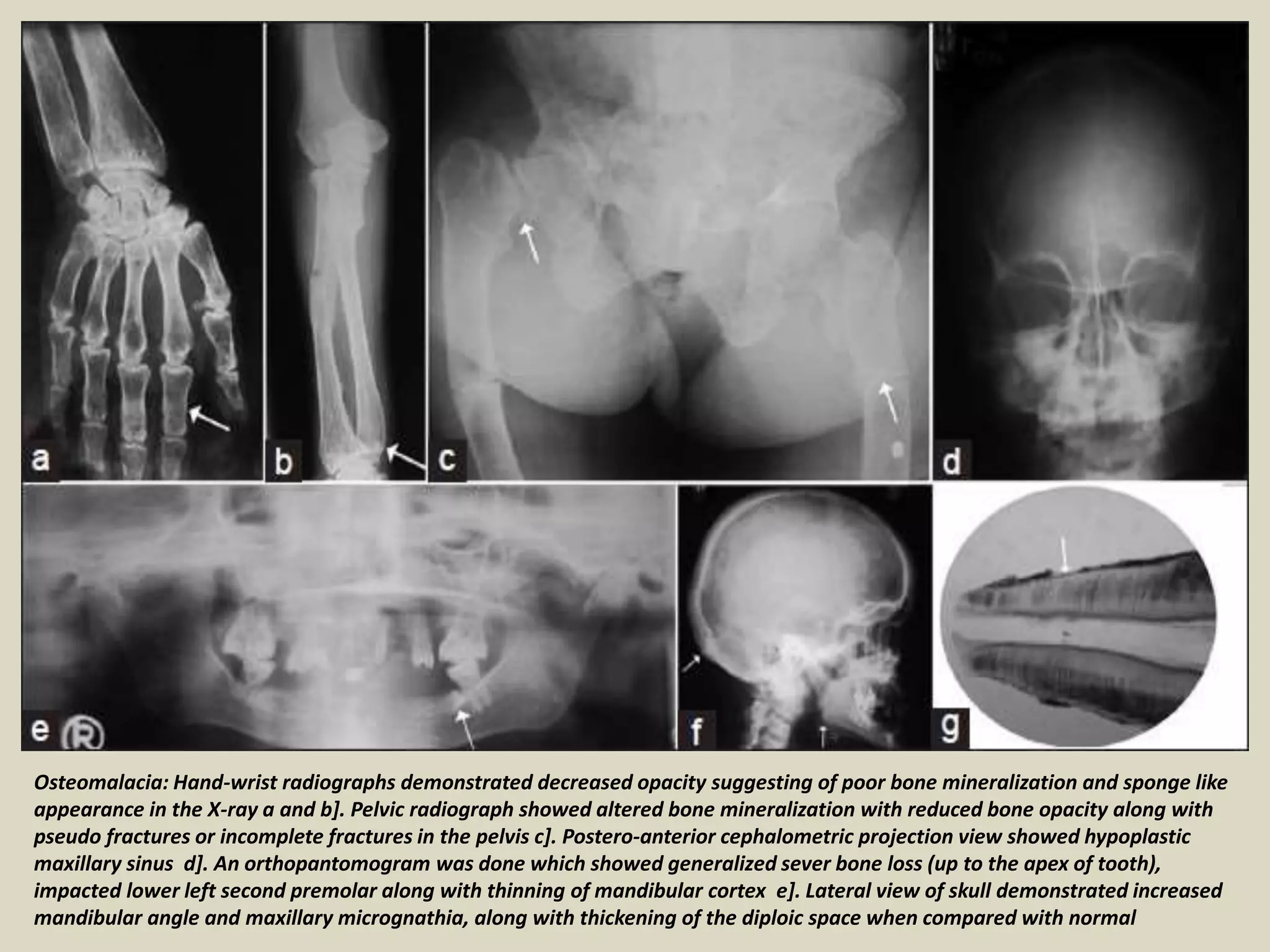 Presentation1.pptx, radiological imaging of metabolic bone diseases. | PPTX | Endocrine and ...