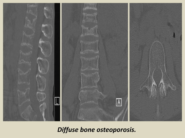 Presentation1.pptx, radiological imaging of metabolic bone diseases. | PPTX | Endocrine and ...